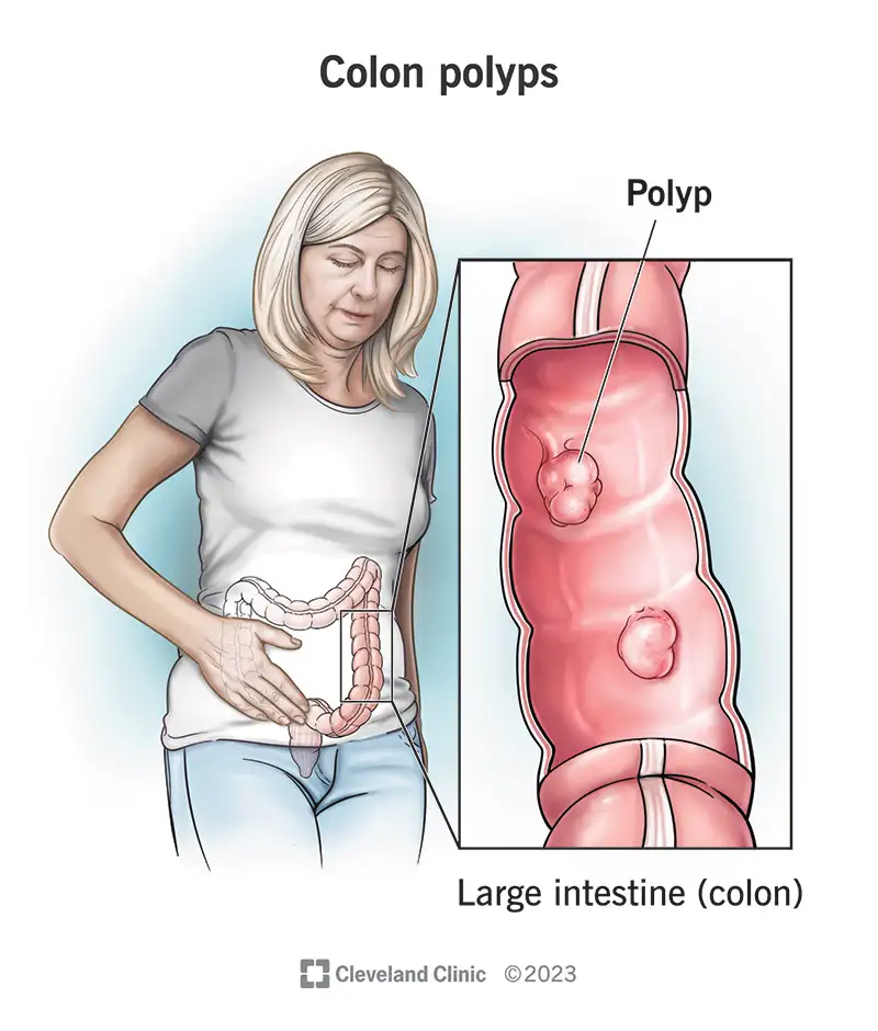 Colon Polyps - dr masoud andalib